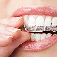 Invisalign Irvine, CA | Invisalign Clear Braces